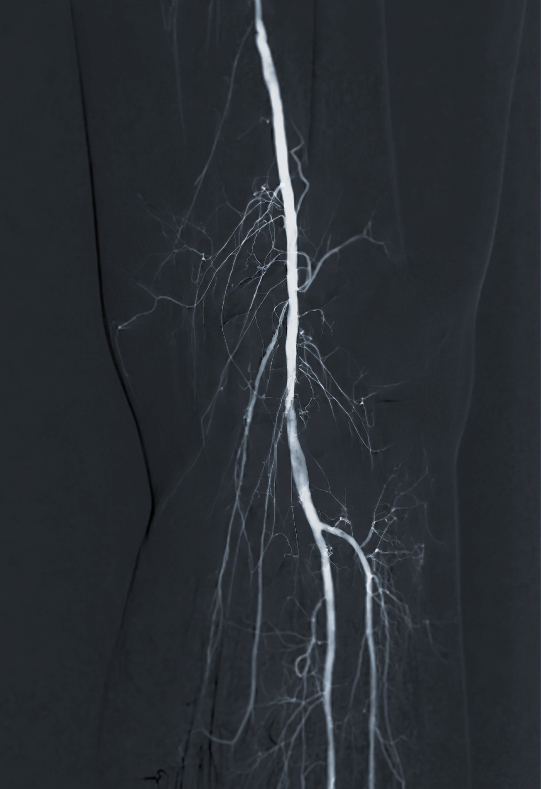 Peripheral Angiogram - Lake Area Cardiology